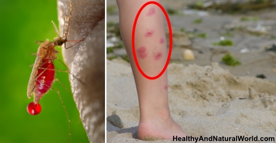 15 Best Natural Ways To Relieve Mosquito Bites 15 Best Natural Ways To Relieve Mosquito Bites