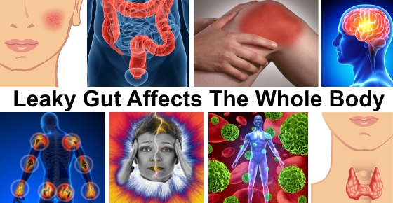 Leaky Gut: What It Is and How to Naturally Heal It