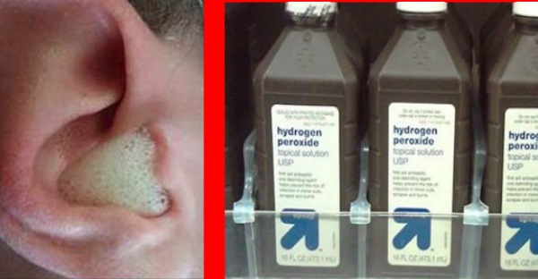 Hydrogen Peroxide In Ear For Ear Wax Removal And Ear Infection